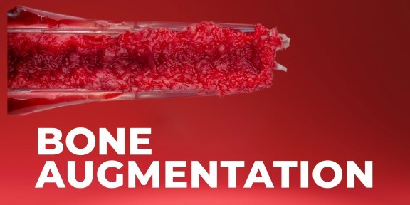 OHI-S Bone Augmentation Current Techniques - Medical amboss